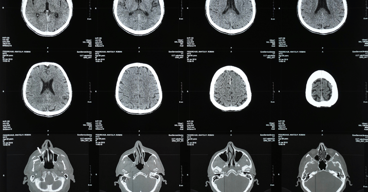 Early Warning Signs of Traumatic Brain Injury After a Mississippi Car ...